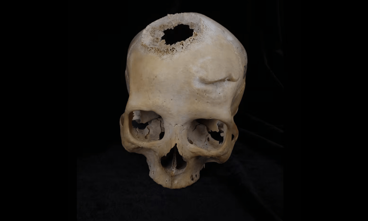 4,000-Year-Old Skull Suggests Early Cancer Surgery in Ancient Egypt ...